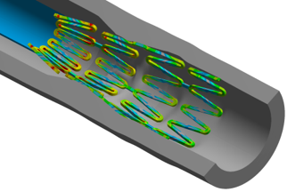 Optimizing Coronary Artery Stents: Ansys Simulation Insights